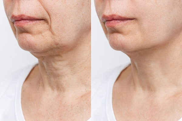 Sagging Jowls & Jawline in Lutz, FL | 4EvaGlow Treatments